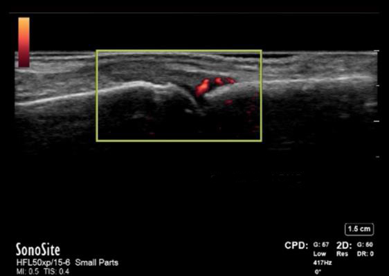 Imagen de la articulación metacarpiana de la mano con sinovitis y ...