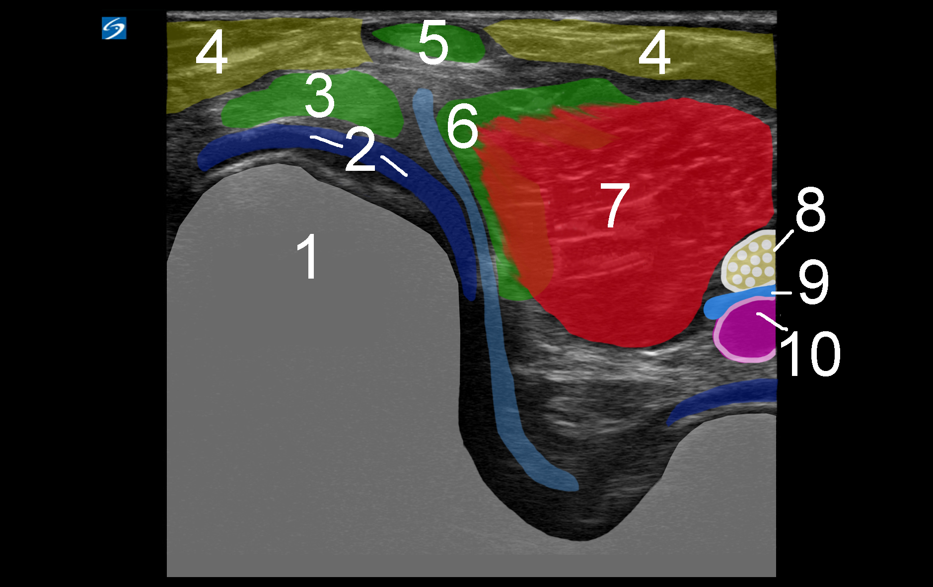 Knee Baker's Cyst Anatomy 4 Image | Sonosite Institute for Point-of ...
