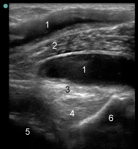 Knee Baker's Cyst Anatomy 4 Image | Sonosite Institute for Point-of ...