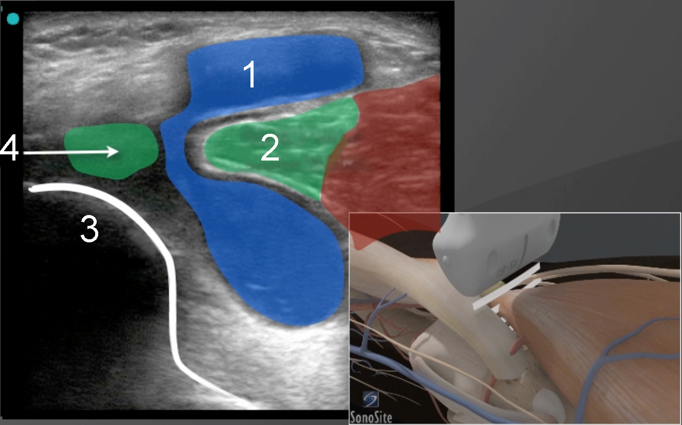 Knee Baker’s Cyst Anatomy 5 Image | Sonosite Institute for Point-of ...