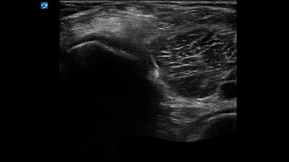 Knee Baker's Cyst Anatomy 6 Image | Sonosite Institute for Point-of ...
