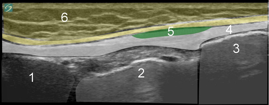 Knee Distal Lateral Collateral Ligament (LCL) Image | Sonosite ...