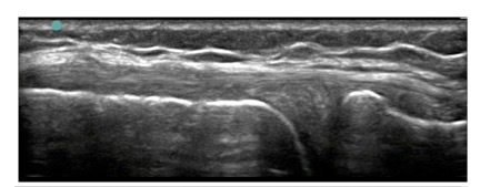 Knee Medial Collateral Ligament (MCL) Thickened Diffuse Inflammatory ...