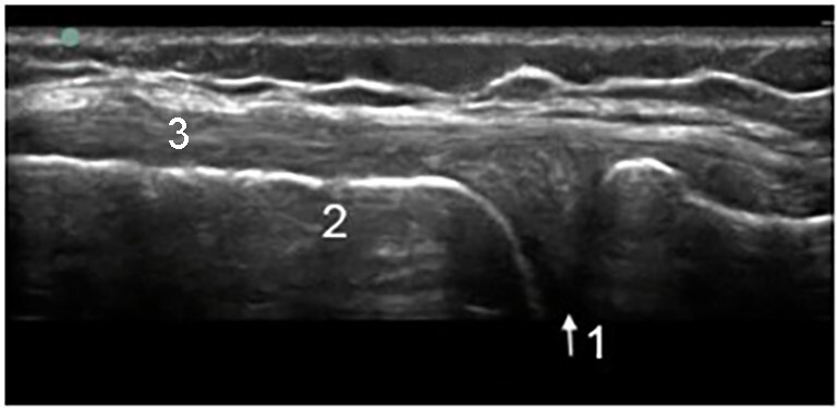 Knee Medial Collateral Ligament (MCL) and Medial Meniscus Image ...