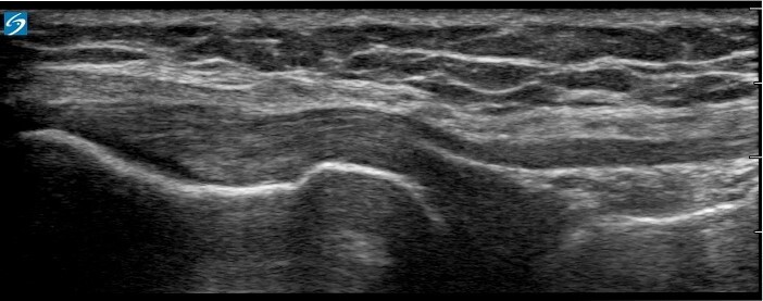 Knee Proximal Lateral Collateral Ligament (LCL) 2 Image | Sonosite ...