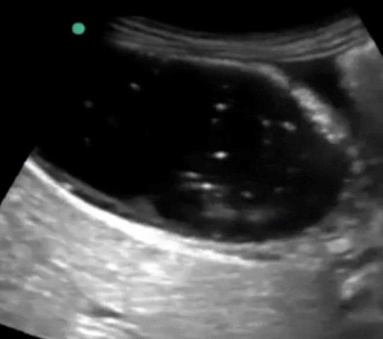 Conducto colédoco mediante ecografía durante signo de Murphy – Imagen ...