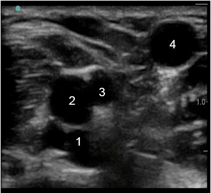 Peripheral IV (PIV) Brachial Vein and Artery and Basilic Vein Image ...