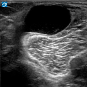 Knee Posterior Medial Knee Baker's Cyst Transverse Image | Sonosite ...
