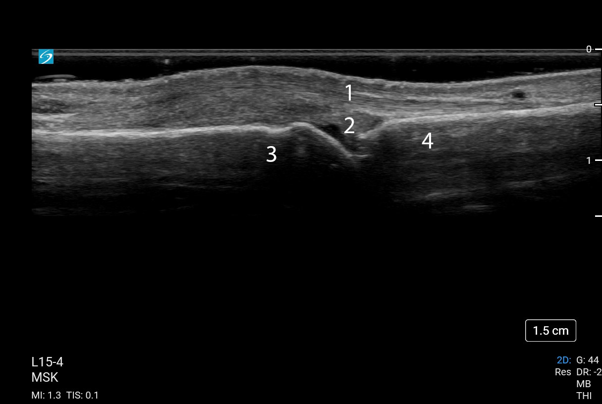 Hand 2nd MCP Joint Long Axis (Sonosite PX L15-4) Image | Sonosite ...
